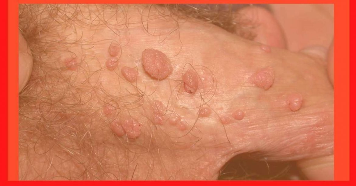 How to Get Rid of Genital Skin Tags